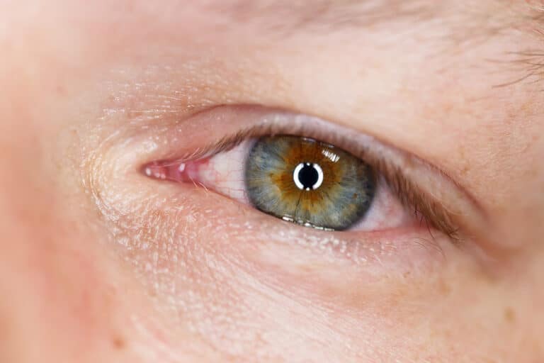 Retinal Tear or Detachment Fort Myers | Frantz EyeCare Naples