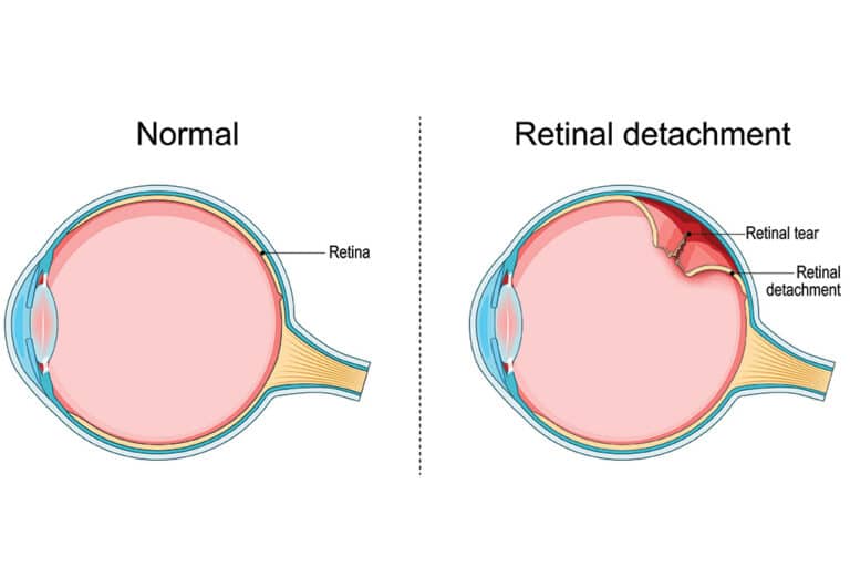 Retinal Tear or Detachment Fort Myers | Frantz EyeCare Naples