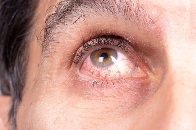 Uveitis Fort Myers | Uveitis Treatment Naples, FL | Frantz EyeCare